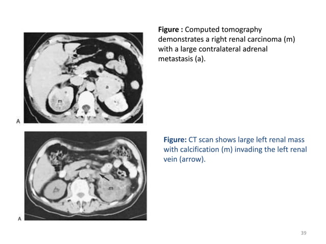 RENAL ANATOMY & RENAL CELL CANCERS | PPTX | Cancer | Diseases and ...
