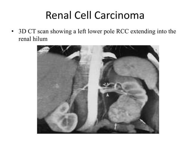 RENAL ANATOMY & RENAL CELL CANCERS | PPTX | Cancer | Diseases and ...