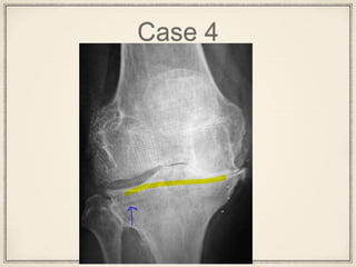 Algorithm to correct Varus Knee in a TKR | PPTX