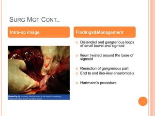 Ileo-sigmoid Knotting | PPTX