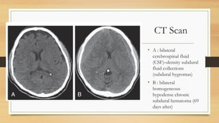ISMT12 - Day 31 - Ambara - Chronic Subdural Hematoma.pptx
