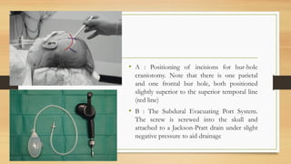 ISMT12 - Day 31 - Ambara - Chronic Subdural Hematoma.pptx