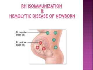 Hemolytic Disease of the newborn ( RH Isoimmunization ) | PPTX