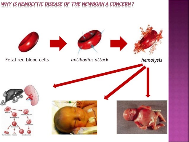 Hemolytic Disease of the newborn ( RH Isoimmunization )
