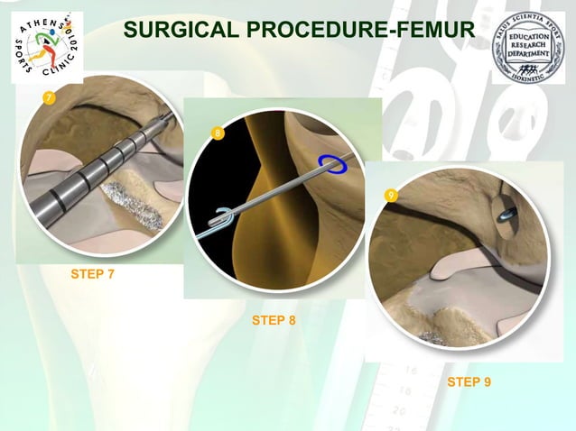 ACL Reconstruction using JewelAcl graft | PPT | Death, Injury, or ...
