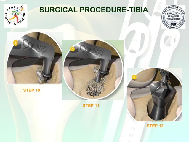 ACL Reconstruction using JewelAcl graft | PPT | Death, Injury, or ...