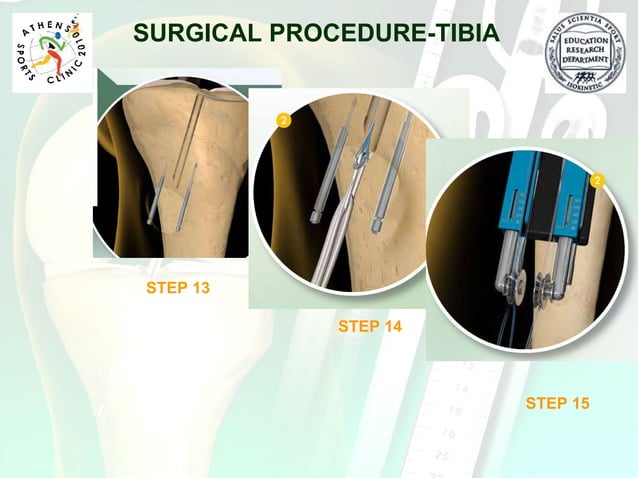 ACL Reconstruction using JewelAcl graft | PPT