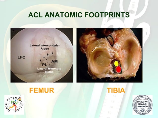 ACL Reconstruction using JewelAcl graft | PPT | Death, Injury, or ...