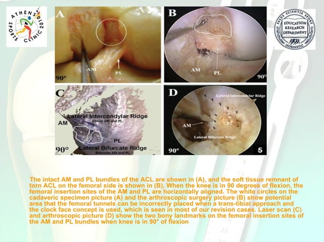 ACL Reconstruction using JewelAcl graft | PPT | Death, Injury, or ...