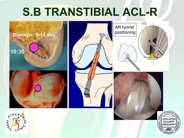 ACL Reconstruction using JewelAcl graft | PPT | Death, Injury, or ...