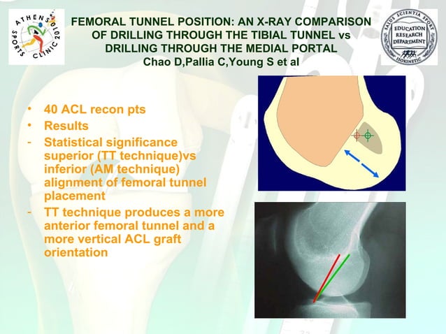 ACL Reconstruction using JewelAcl graft | PPT