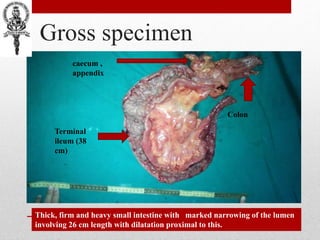 Isolated intestinal ganglioneuromatosis | PPTX | Digestive Disorders ...