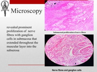 Isolated intestinal ganglioneuromatosis | PPTX | Digestive Disorders ...