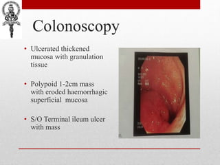Isolated intestinal ganglioneuromatosis | PPTX | Digestive Disorders ...