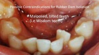 Isolation in endodontics | PPTX