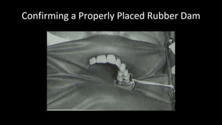 Isolation in endodontics | PPTX