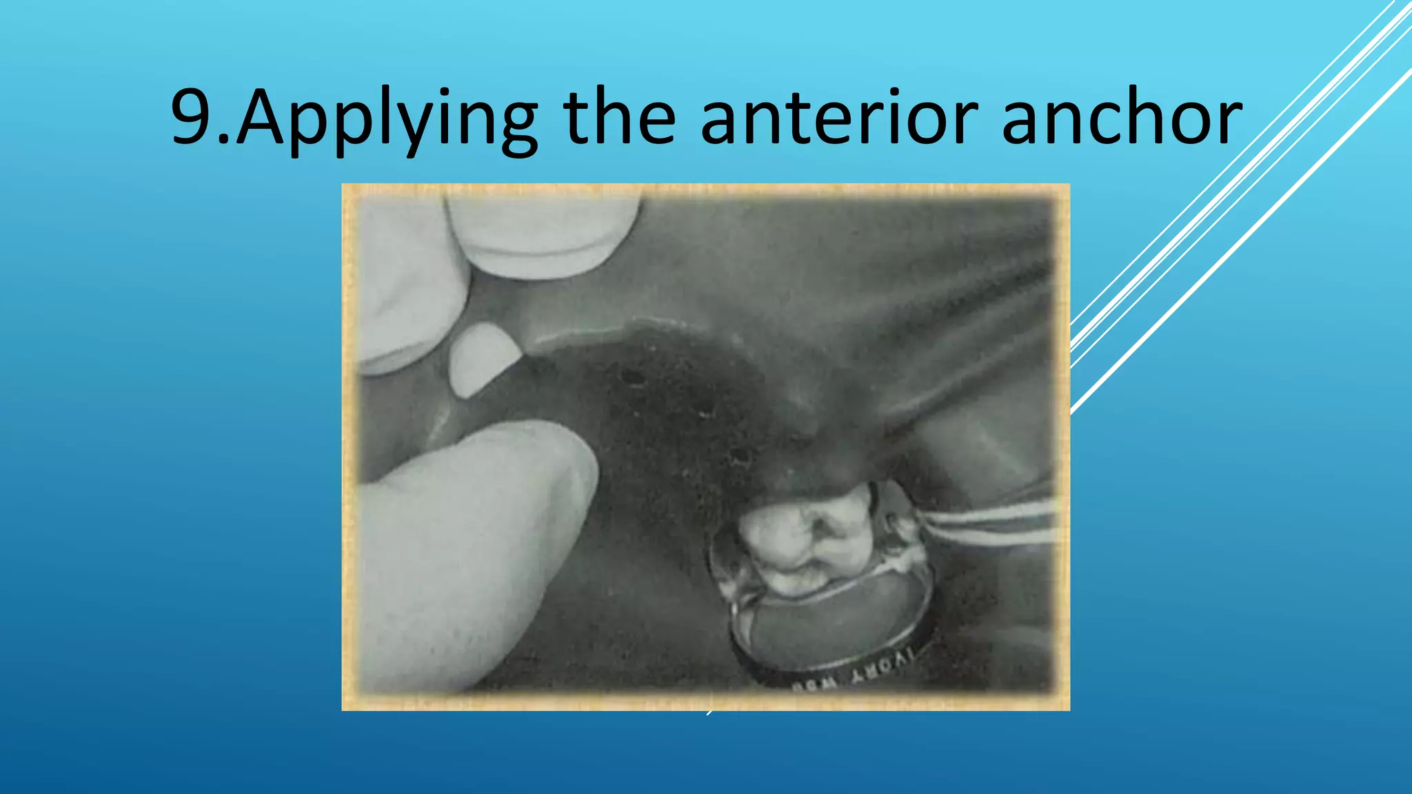 Isolation of the operative field | PPTX