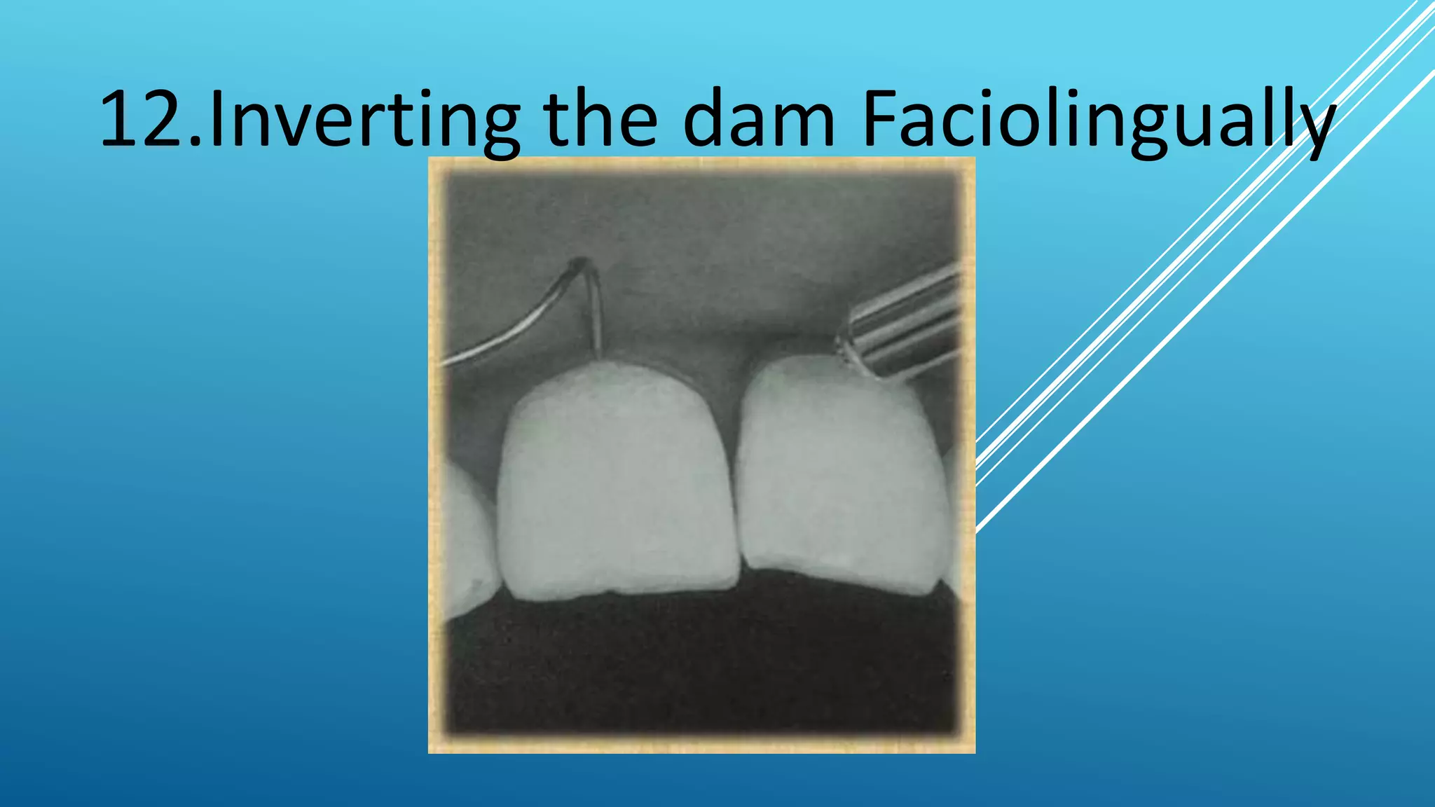 Isolation of the operative field | PPTX | Dental Health | Diseases and ...