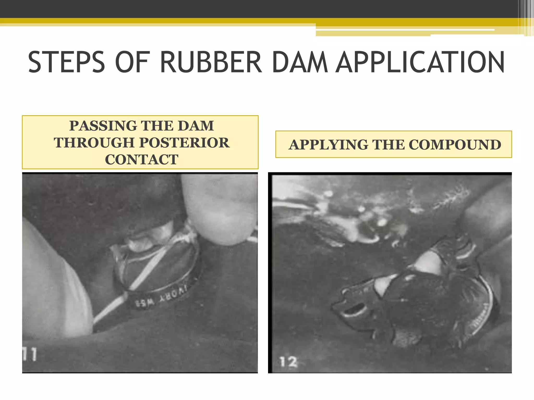 Isolation: The Rubber Dam | PPTX