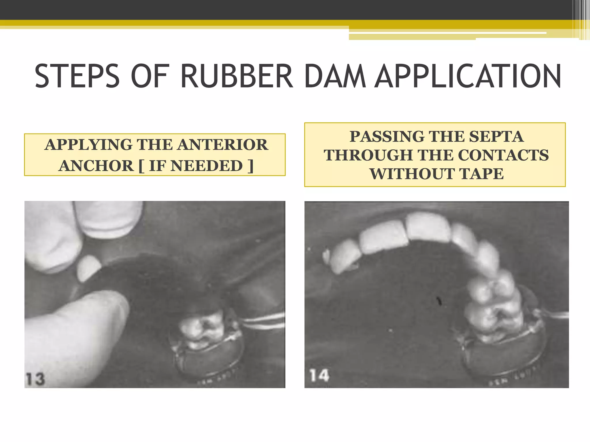 Isolation: The Rubber Dam | PPTX