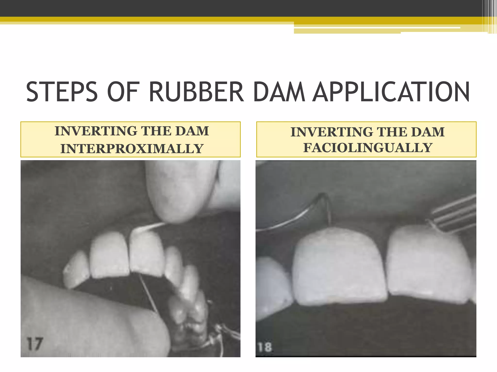 Isolation: The Rubber Dam | PPTX