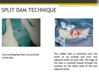 Isolation: The Rubber Dam | PPTX