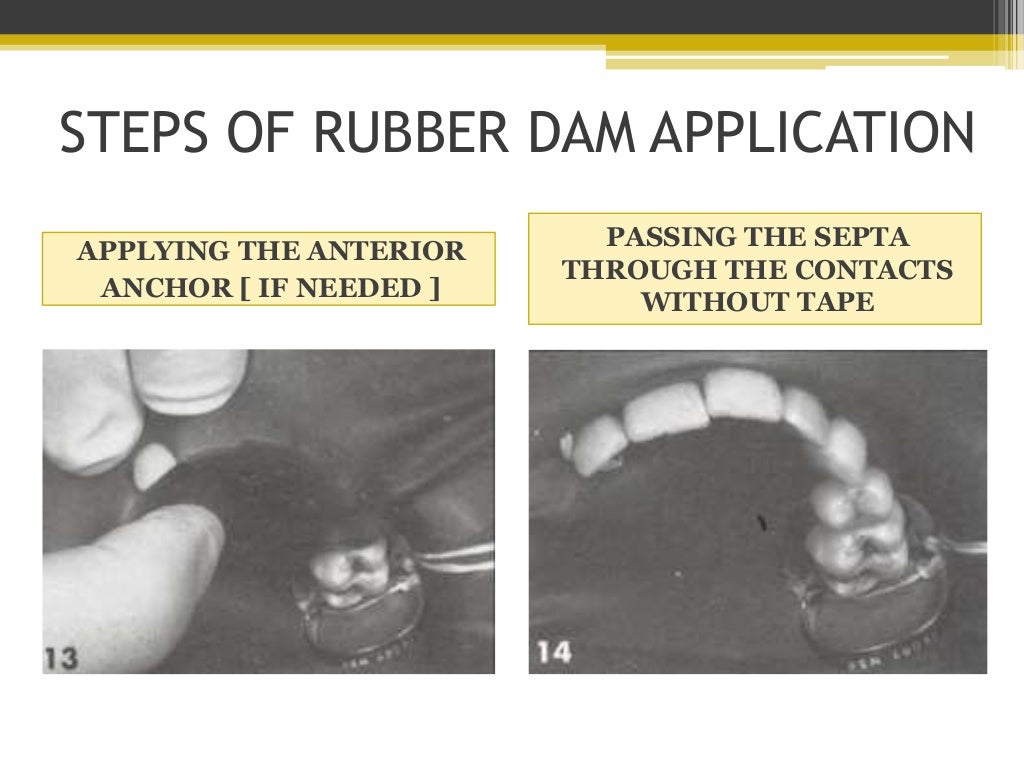 Isolation: The Rubber Dam