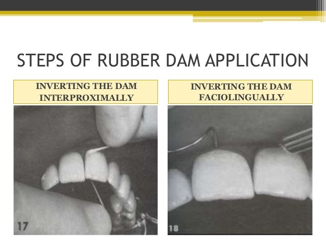 Isolation: The Rubber Dam