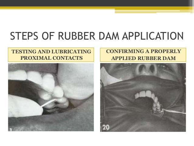 Isolation: The Rubber Dam