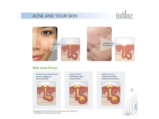 Isolaz for Acne - View Binder | PPTX