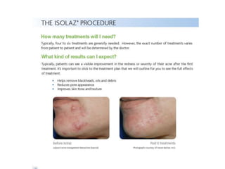 Isolaz for Acne - View Binder | PPTX