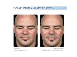 Isolaz for Acne - View Binder | PPT