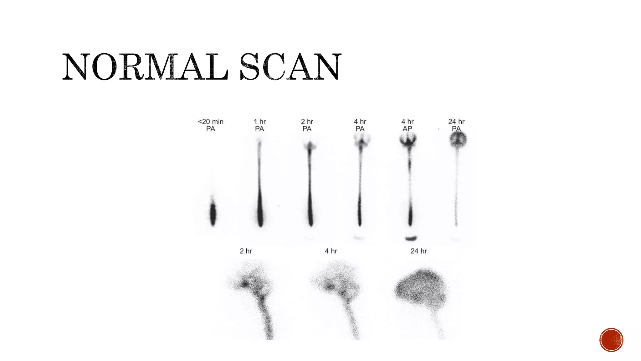 Application of isotope cisternography | PPTX