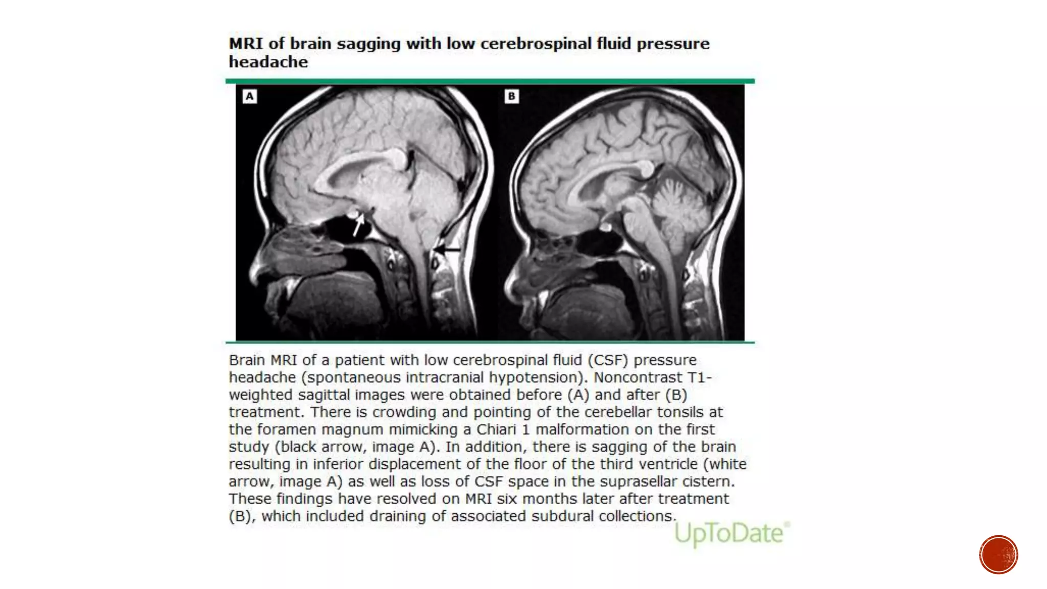 Application of isotope cisternography | PPTX