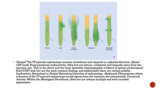 Application of isotope cisternography | PPTX