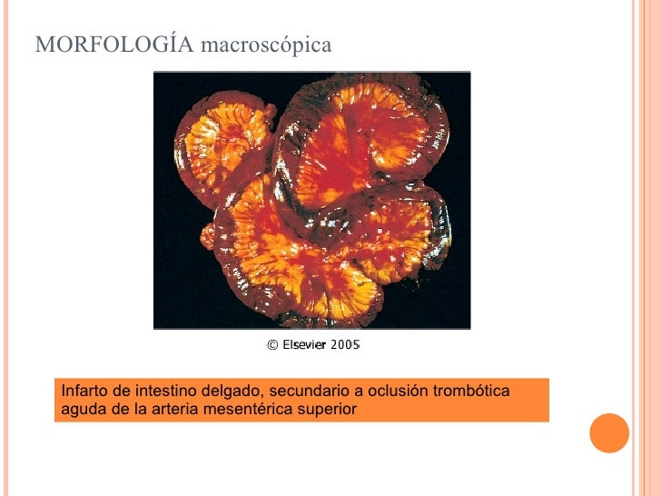 Isquemia Intestinal