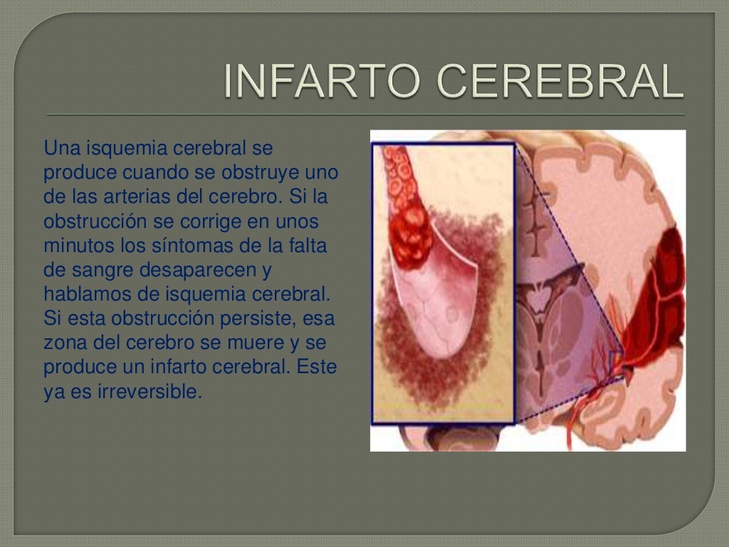 Isquemia Cerebral