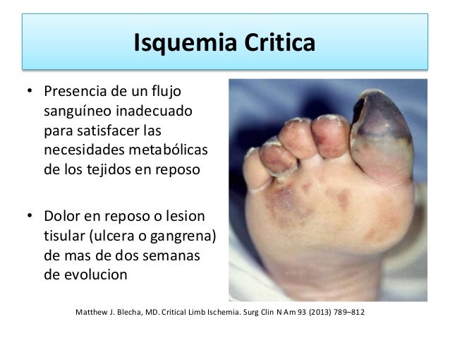 Isquemia critica y aguda de las extremidades