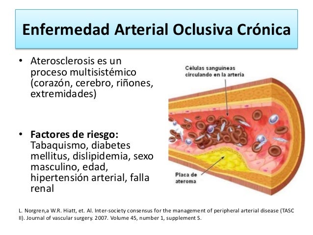 Isquemia Arterial Aguda | Isquemia arterial: causas y tratamientos – HDRWPT