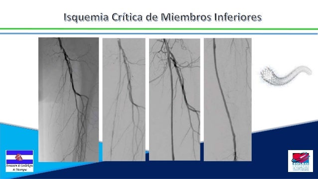 Isquemia Crítica de Miembros Inferiores