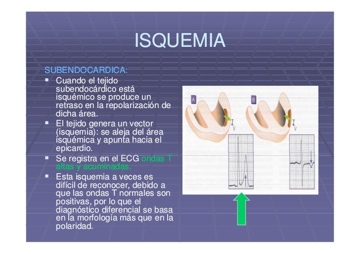 Isquemia, Lesion Y Necrosis
