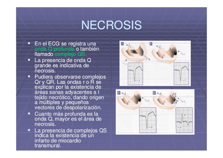 Isquemia, Lesion Y Necrosis