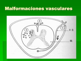 Isquemia medular | PPT