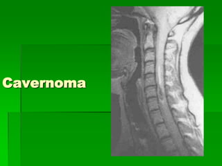 Isquemia medular | PPT
