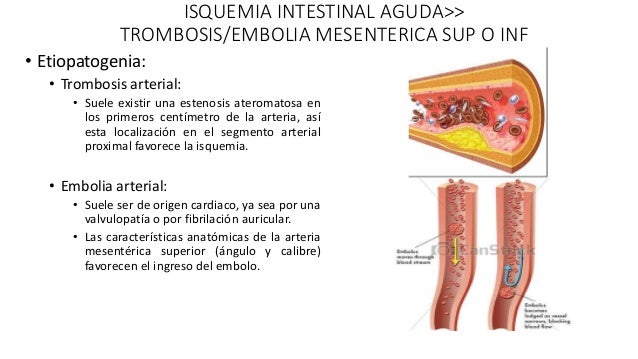Isquemia mesenterica