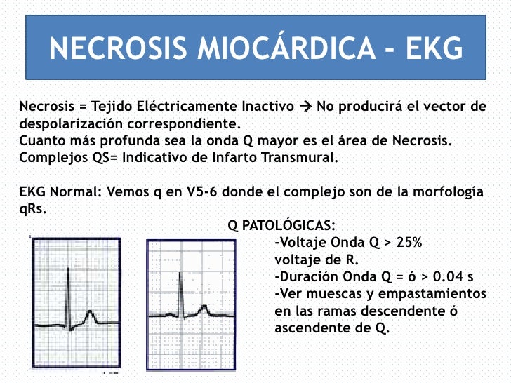 EKG Isquemia