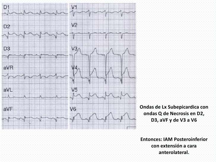 EKG Isquemia