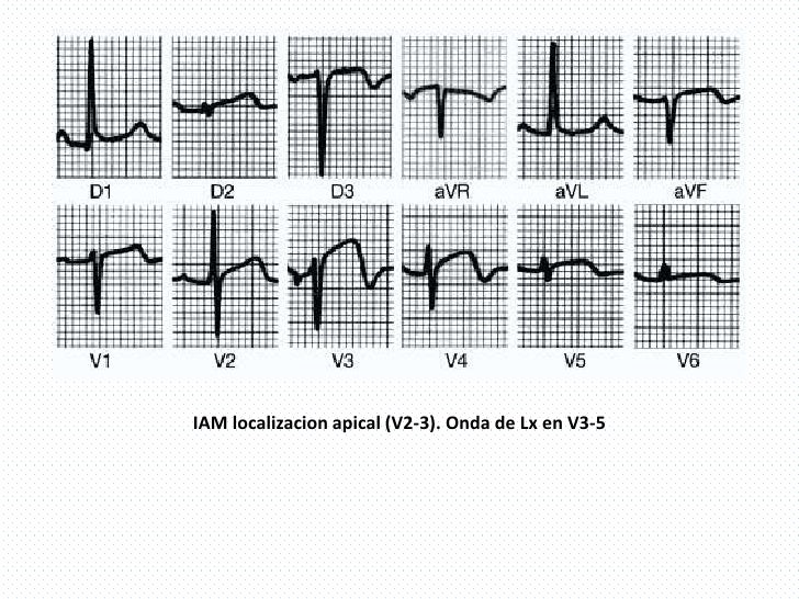 EKG Isquemia