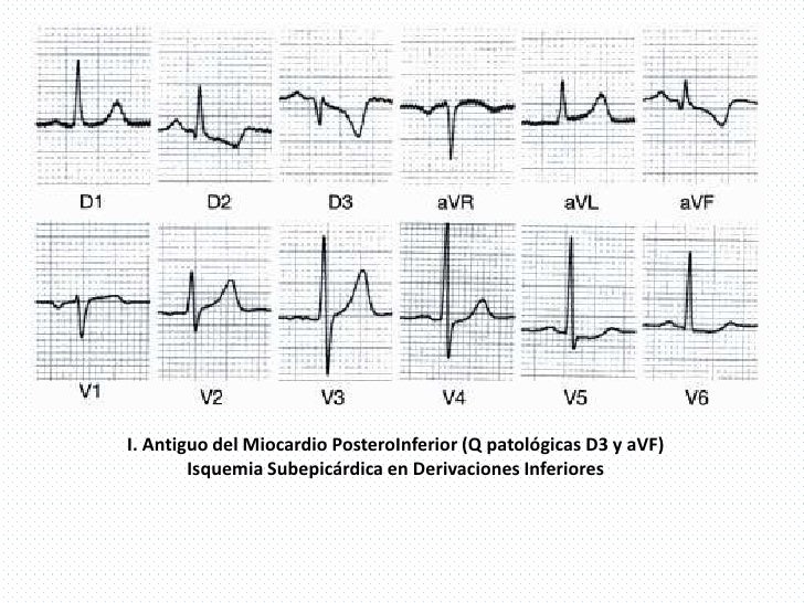 EKG Isquemia