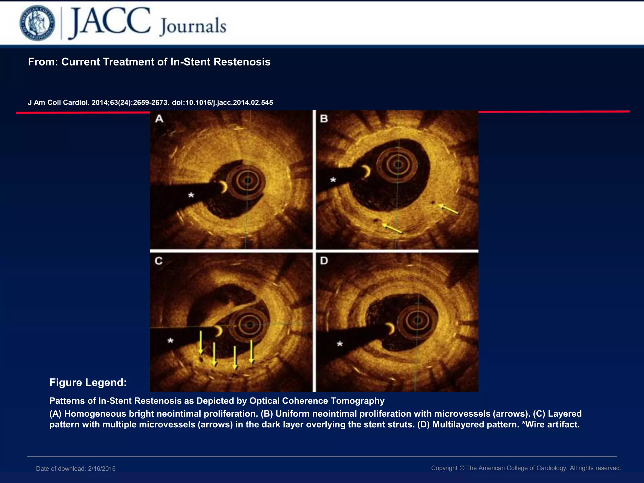 In stent re stenosis | PPTX